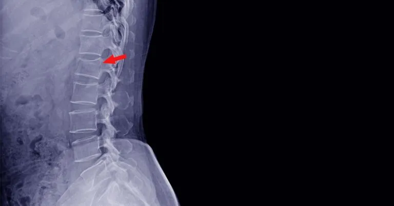 Kyphoplasty Treatment in Alpharetta, GA (Atlanta Area)