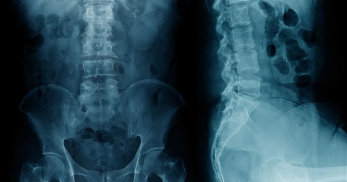 Bone Spurs On Spine: What You Should Know