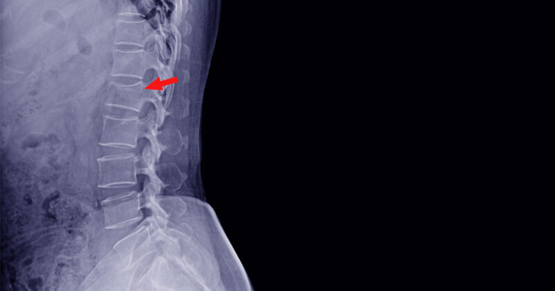 Kyphoplasty Treatment in Alpharetta, GA (Atlanta Area)